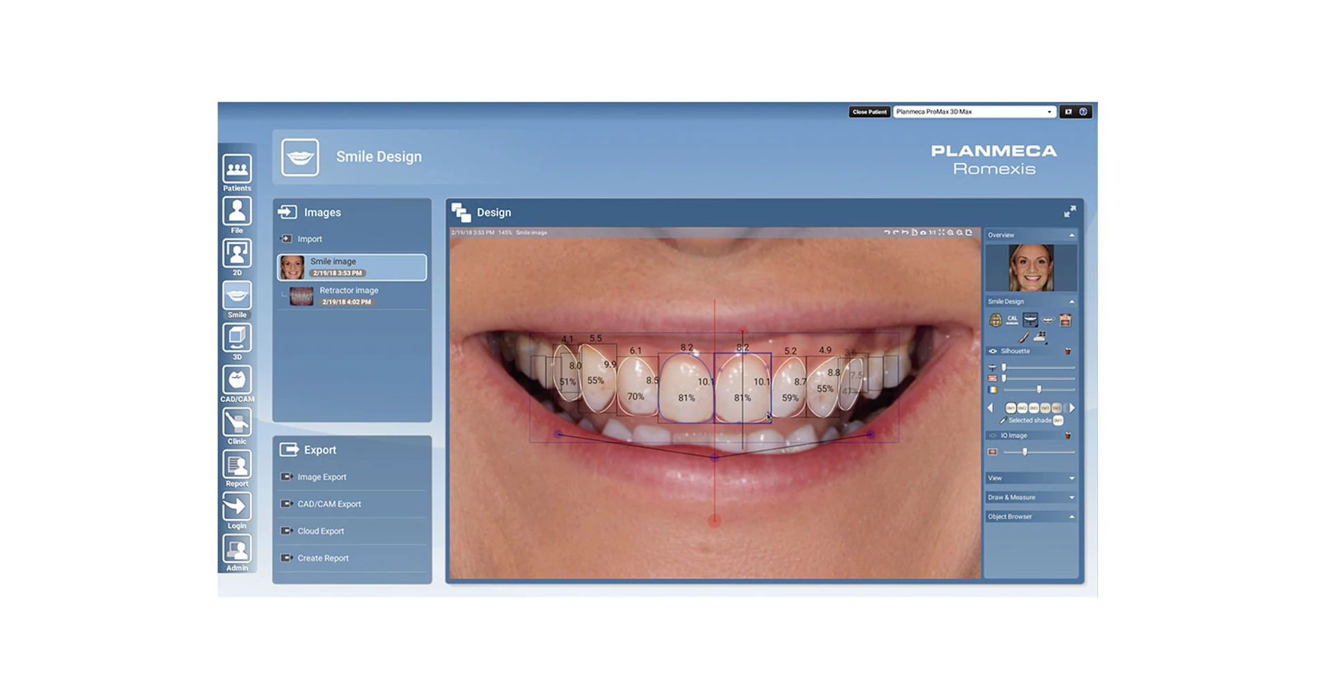 Romexis Smile Design Modul - Planmeca