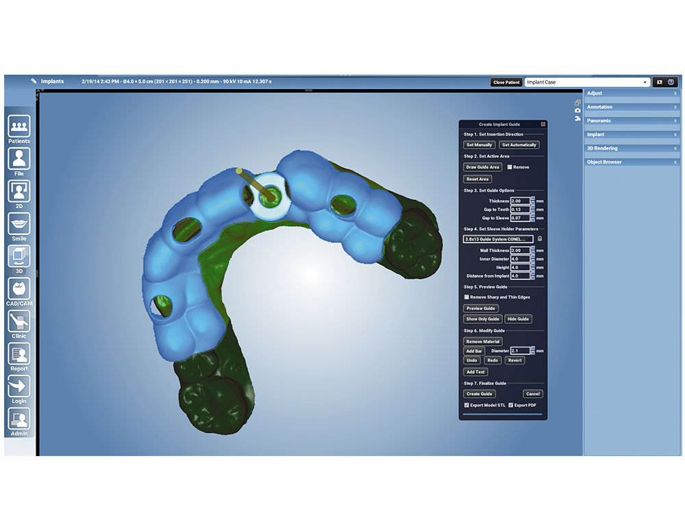 Romexis 3D Implant Guide - Planmeca