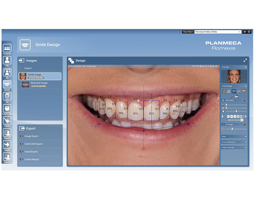 Romexis Smile Design Modul - Planmeca